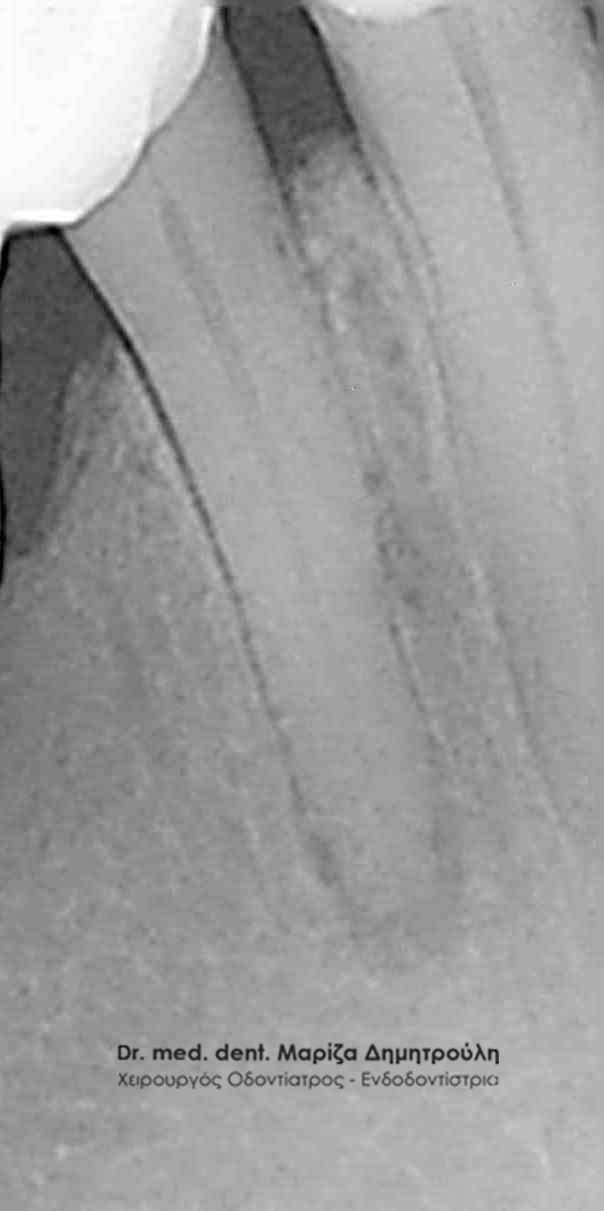 Απονεύρωση δοντιού / Dr. Μαρίζα Δημητρούλη Οδοντίατρος Θεσσαλονίκη, Θέρμη