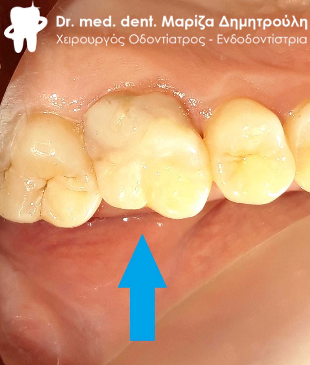 Λευκό σφράγισμα δοντιού - Dr. Med. Dent. Μαρίζα Δημητρούλη