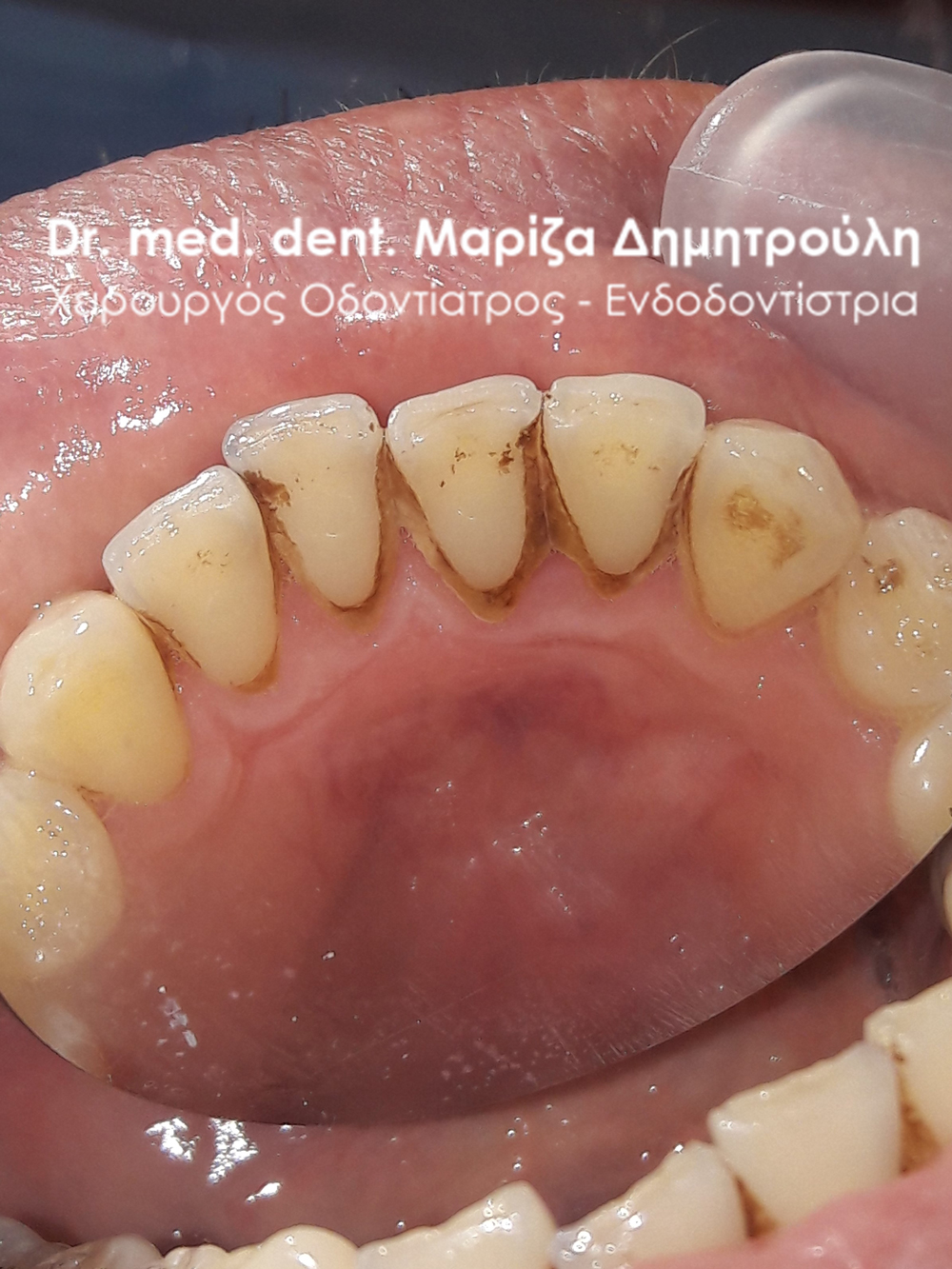 Καθαρισμός δοντιών / Dr. Med. Dent. Μαρίζα Δημητρούλη