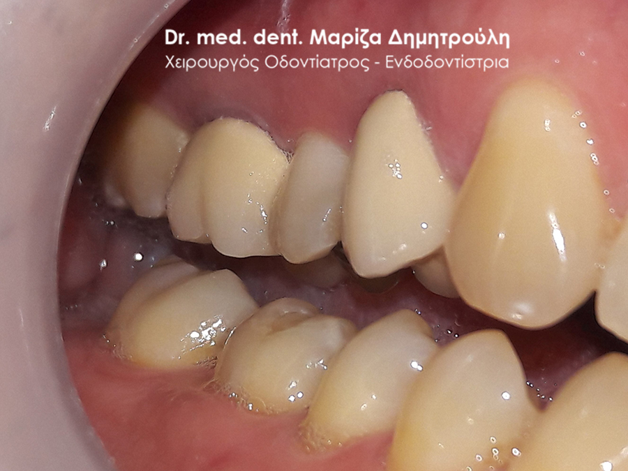 Περιστατικά απονεύρωσης δοντιού / Dr. Med. Dent. Μαρίζα Δημητρούλη