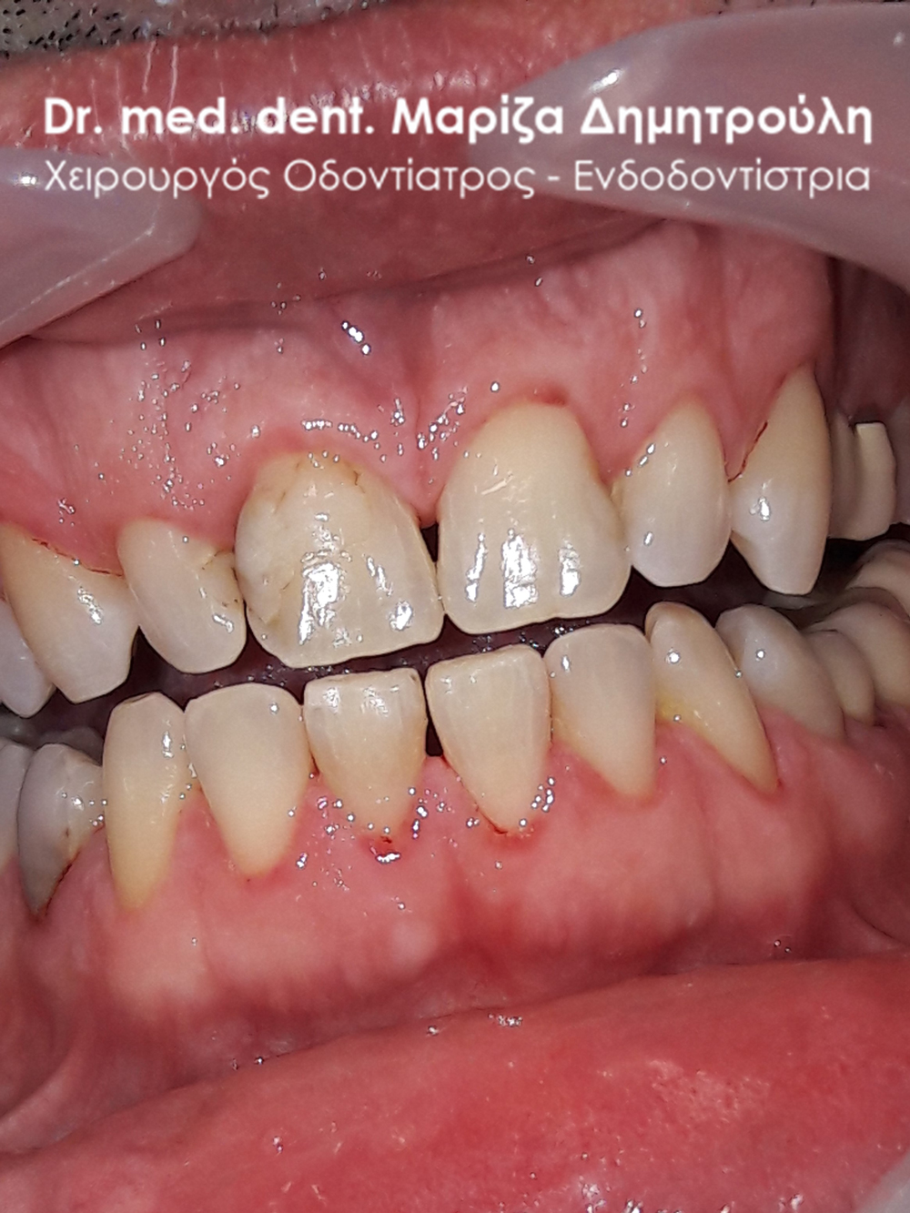 Καθαρισμός δοντιών / Dr. Med. Dent. Μαρίζα Δημητρούλη