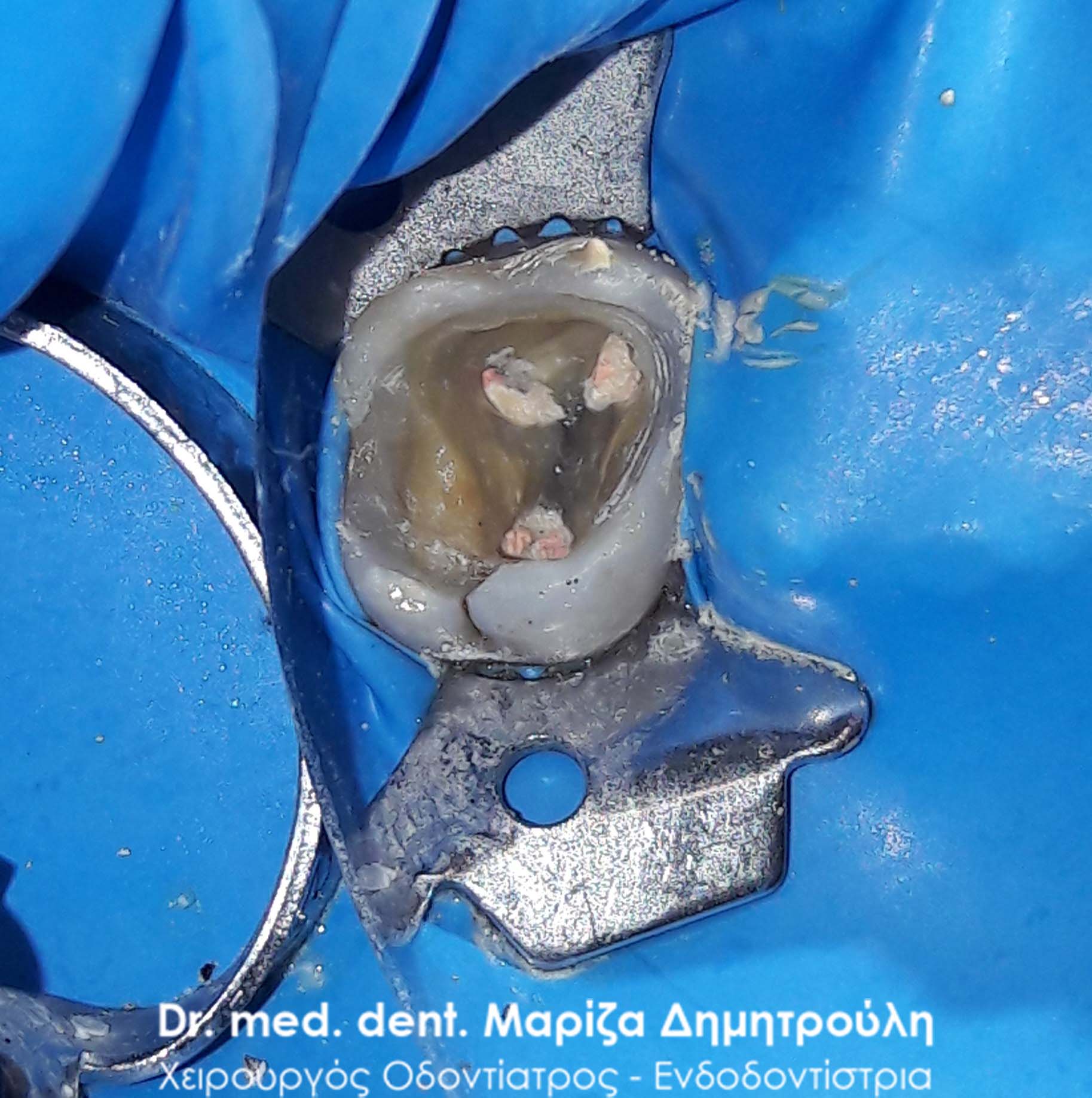 Περιστατικά απονεύρωσης δοντιού / Dr. Med. Dent. Μαρίζα Δημητρούλη
