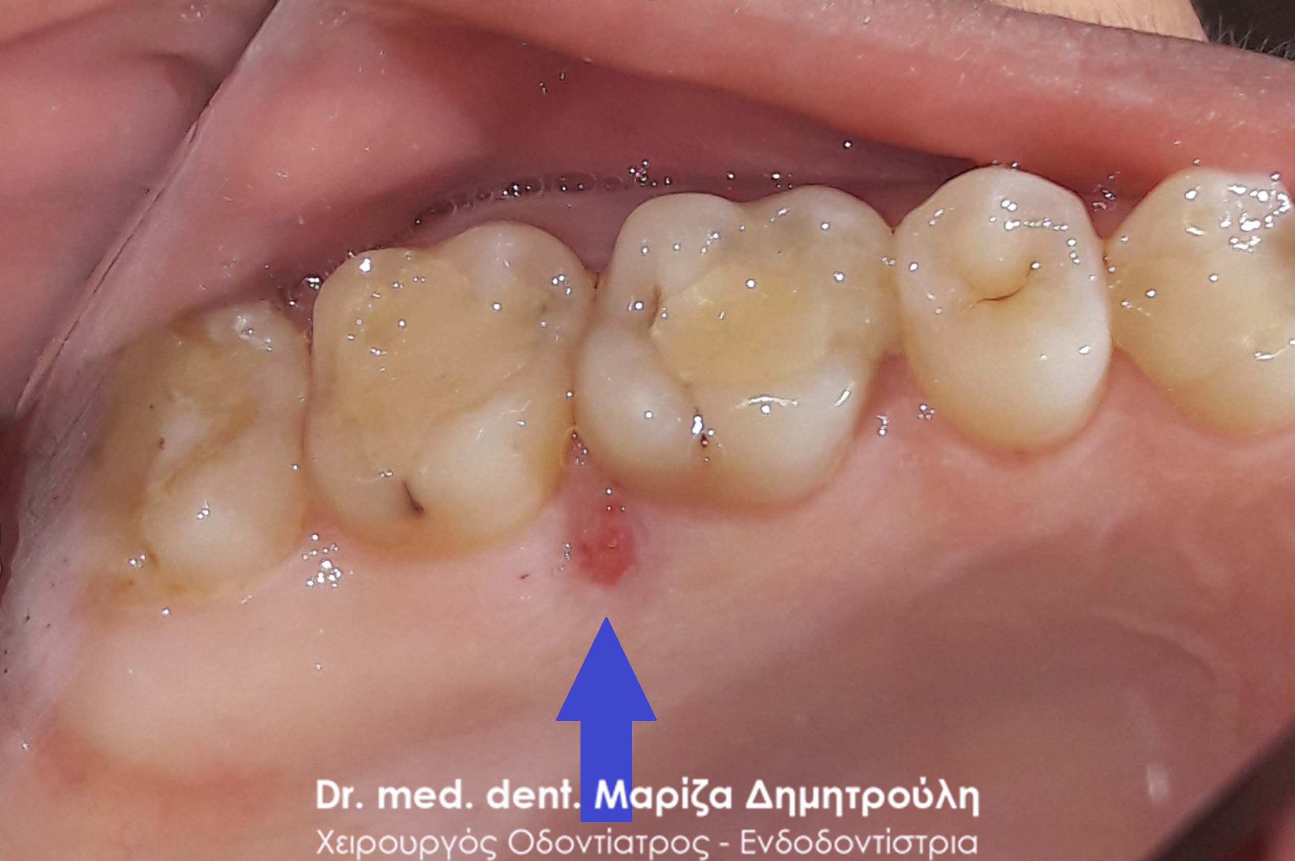 Περιστατικά απονεύρωσης δοντιού / Dr. Med. Dent. Μαρίζα Δημητρούλη
