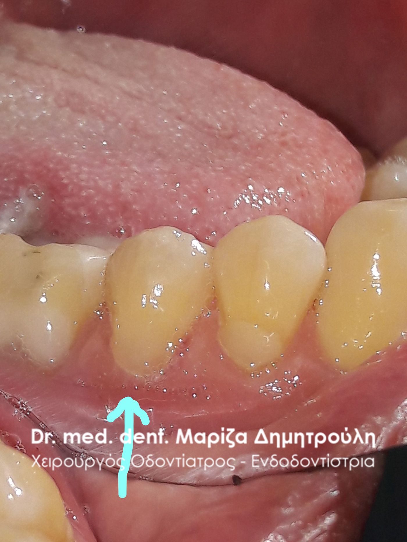 Περιστατικά - Σφραγίσματα δοντιού / Dr. Med. Dent. Μαρίζα Δημητρούλη