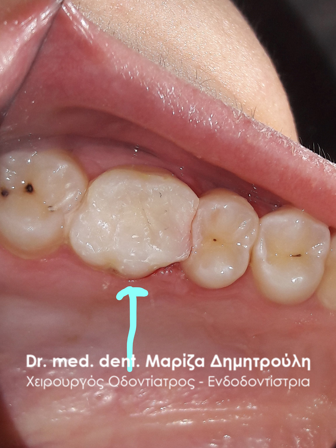Λευκό σφράγισμα δοντιού - Dr. Med. Dent. Μαρίζα Δημητρούλη