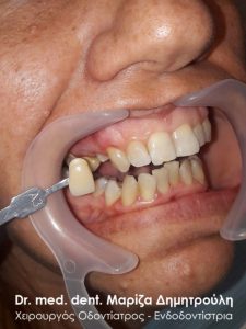 Στεφάνες και γέφυρες δοντιών - Dr. Μαρίζα Δημητρούλη - Οδοντίατρος στη ...