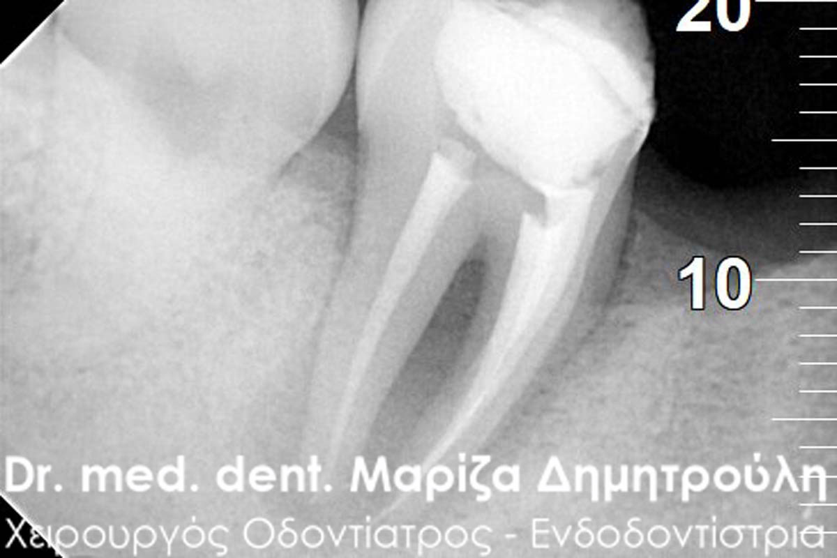 Λευκό σφράγισμα δοντιού - Dr. Med. Dent. Μαρίζα Δημητρούλη