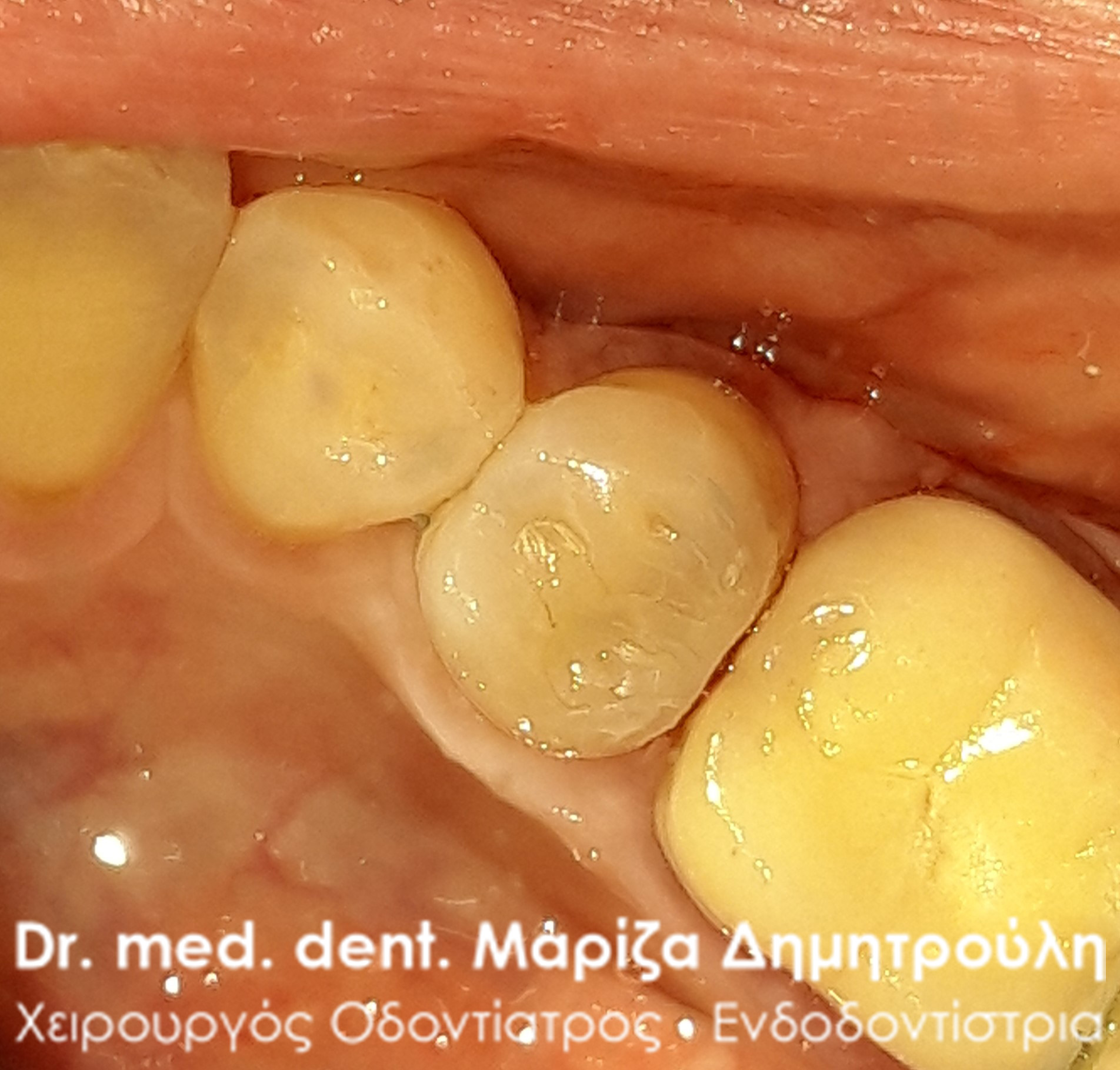 Λευκό σφράγισμα δοντιού - Dr. Med. Dent. Μαρίζα Δημητρούλη