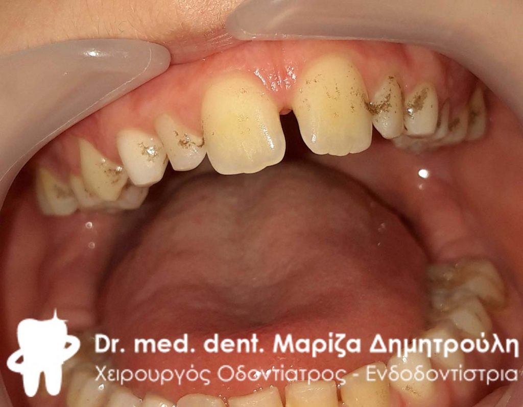 Μαύρα στίγματα σε παιδικά δόντια - Dr. Med. Dent. Μαρίζα Δημητρούλη