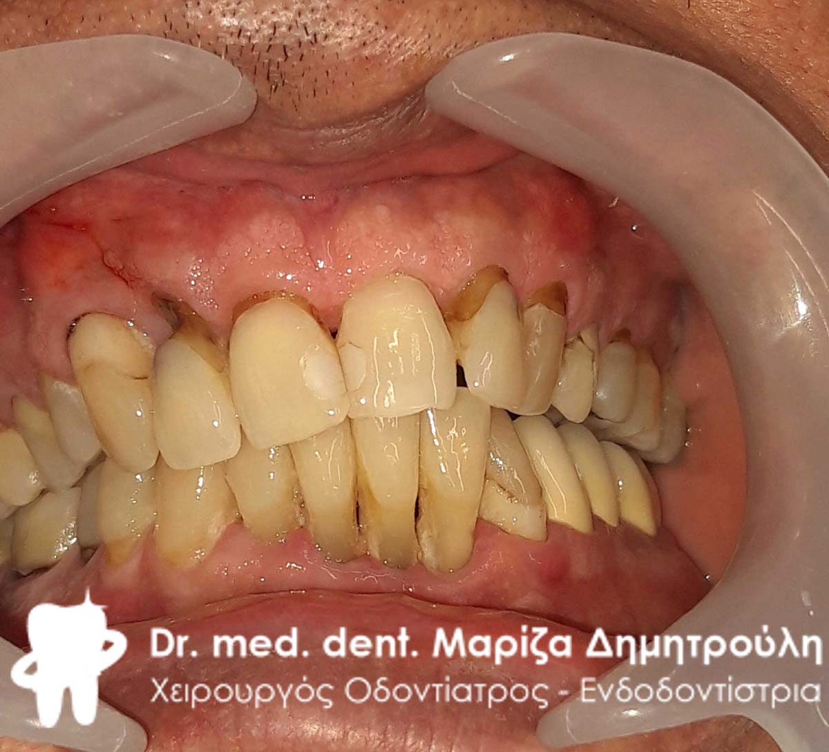 Θεραπεία ουλίτιδα - περιοδοντίτιδα - Dr. Med. Dent. Μαρίζα Δημητρούλη
