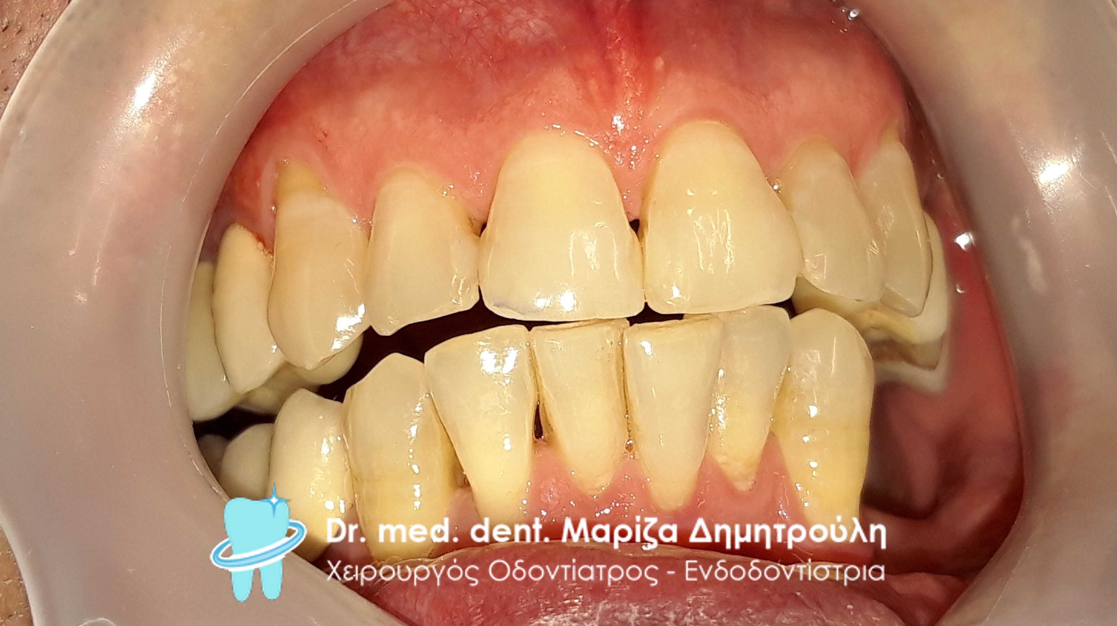 Θεραπεία ουλίτιδα - περιοδοντίτιδα - Dr. Med. Dent. Μαρίζα Δημητρούλη