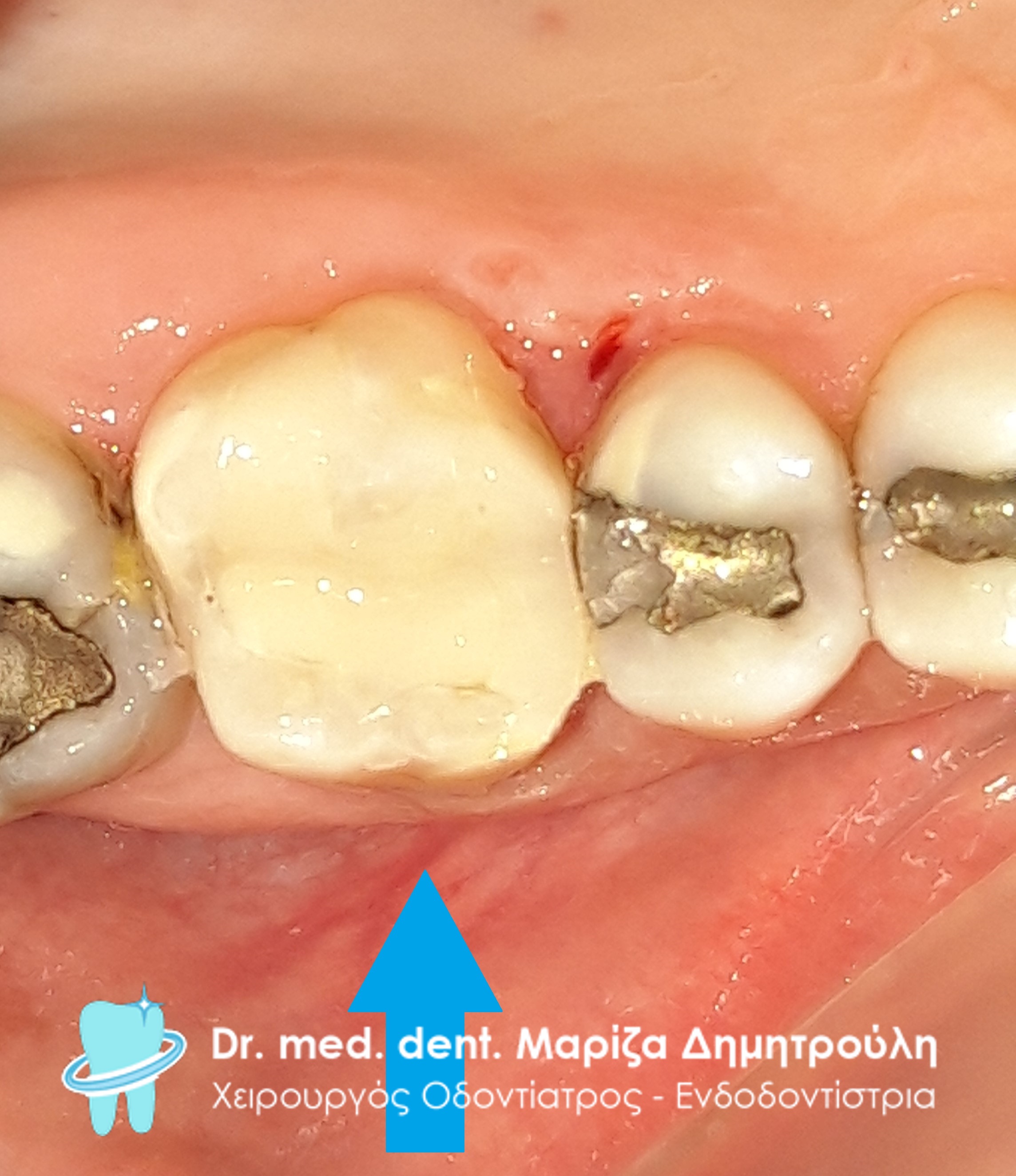 Αλλαγή μαύρου σφραγίσματος - Dr. Med. Dent. Μαρίζα Δημητρούλη
