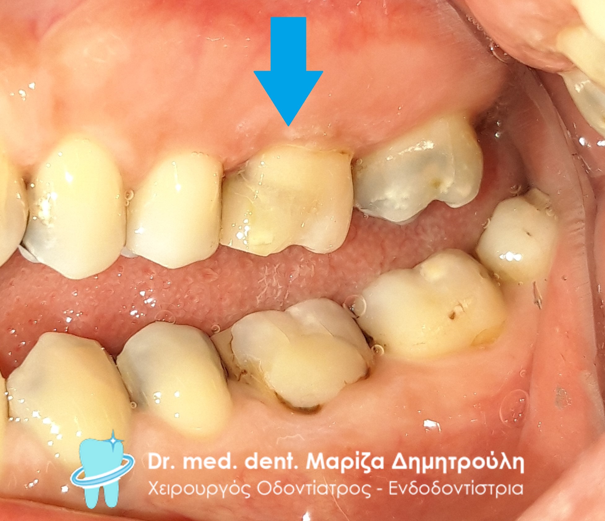 Αλλαγή μαύρου σφραγίσματος - Dr. Med. Dent. Μαρίζα Δημητρούλη
