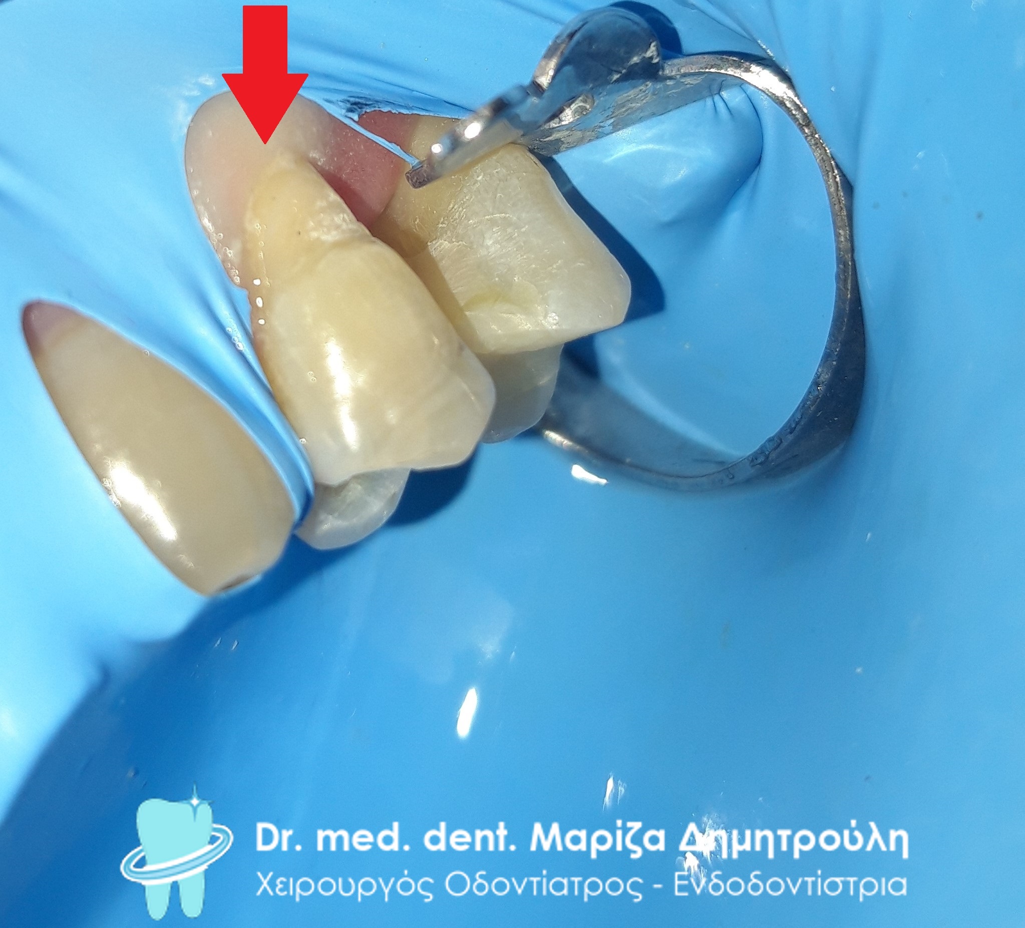 Αυχενικό σφράγισμα δοντιού - Dr. Med. Dent. Μαρίζα Δημητρούλη