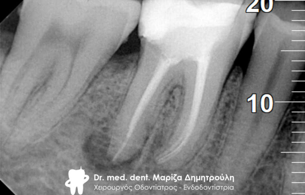 Επανάληψη απονεύρωσης δοντιού - Dr. Med. Dent. Μαρίζα Δημητρούλη