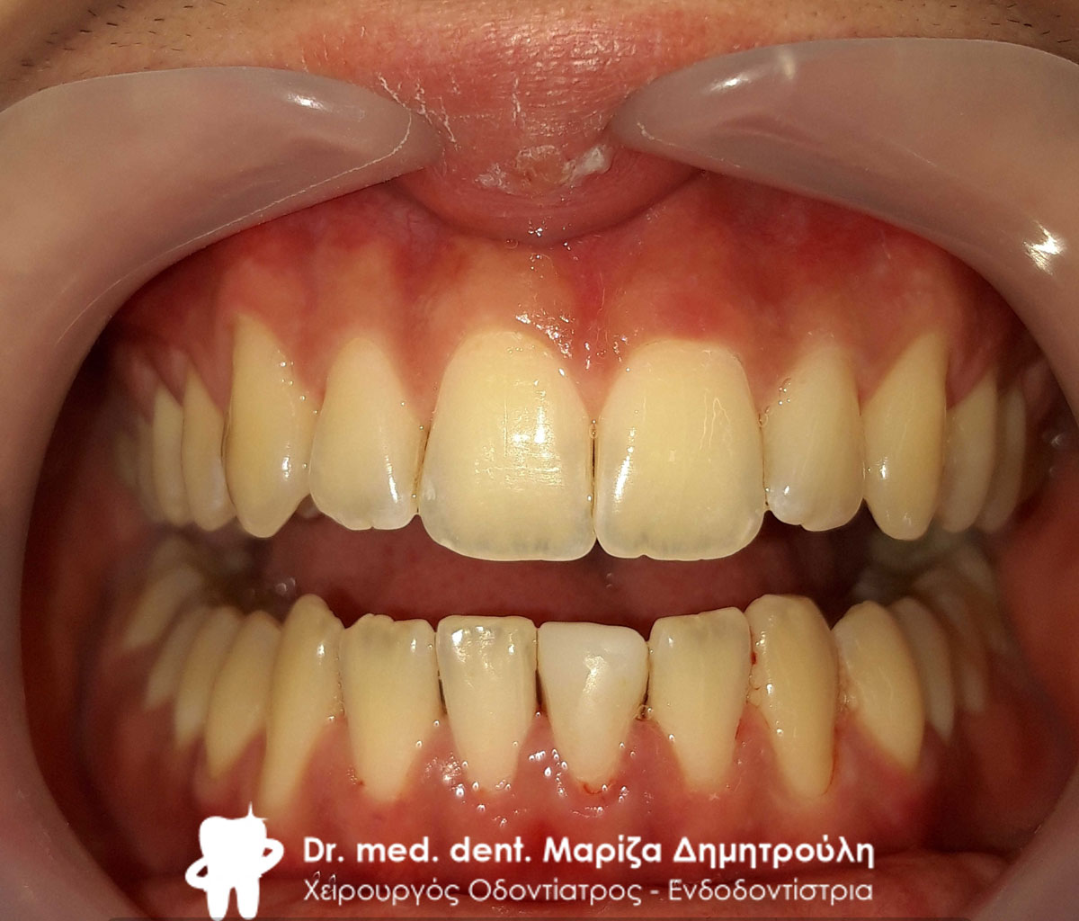 Θεραπεία ουλίτιδα - περιοδοντίτιδα - Dr. Med. Dent. Μαρίζα Δημητρούλη
